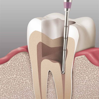 HM191A-018-RAL Long Neck Endo Access Bur, Carbide Cutting Tip, Round, 1 ...