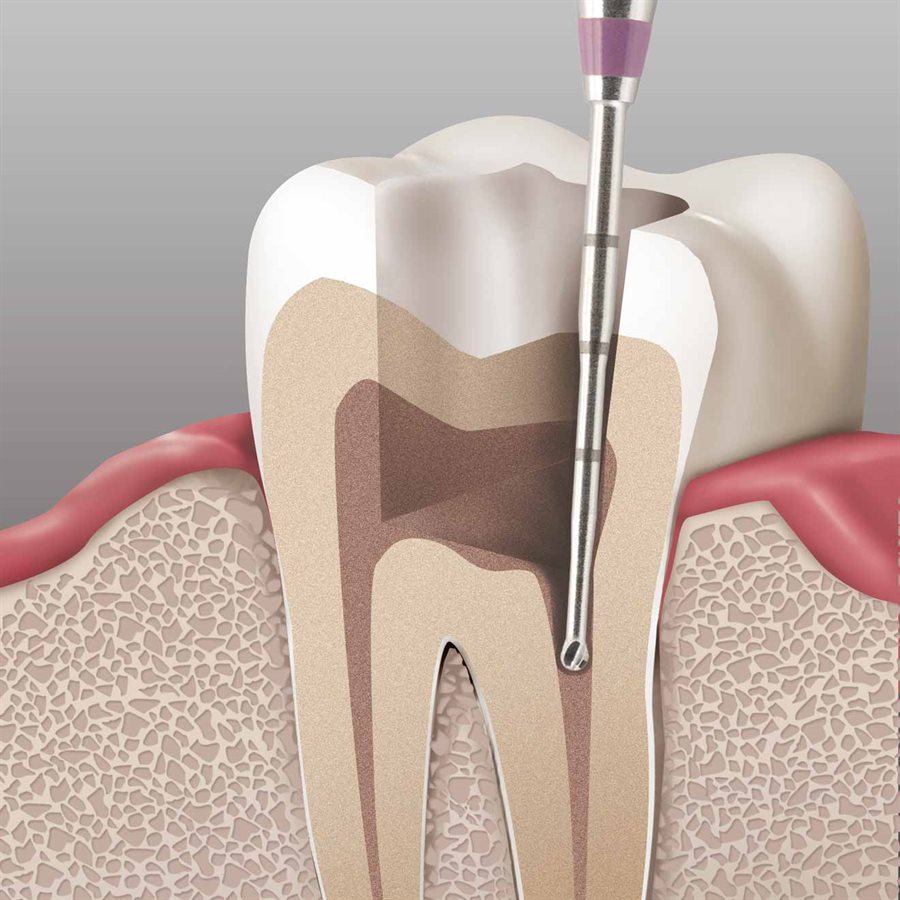 HM191A-006-RAL Long Neck Endo Access Bur, Carbide Cutting Tip, Round, 0 ...