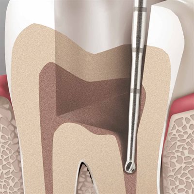 HM191A-012-RAL Long Neck Endo Access Bur, Carbide Cutting Tip, Round, 1 ...