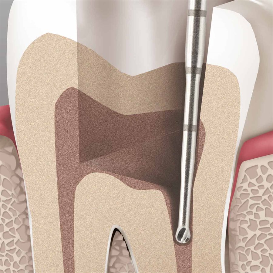 HM191A-010-RAL Long Neck Endo Access Bur, Carbide Cutting Tip, Round ...